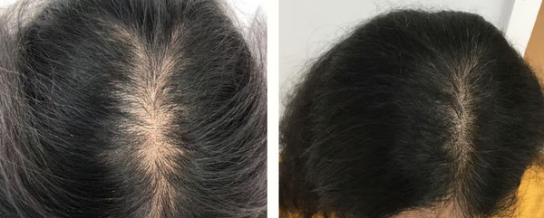 Female Hair Filler – Pharmacillin